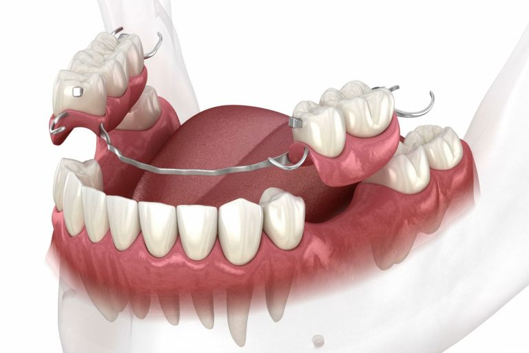 Dental Flipper vs Dental Implant What You Need to Know